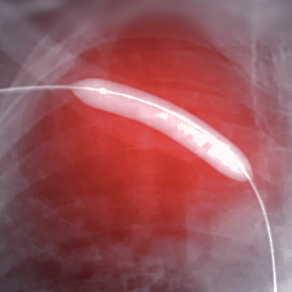 How Balloon Sinus Dilation Works to Relieve Sinus Pain | Learn more at ...